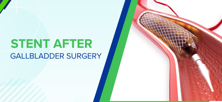 Stent After Gallbladder Surgery | Dr. Vipulroy Rathod